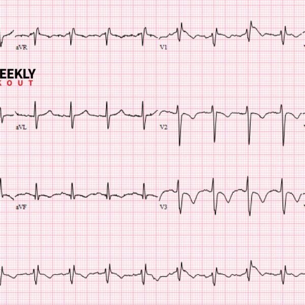 Pulmonary Embolism – ECG Weekly