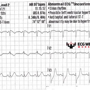 STEMI Equivalent – ECG Weekly