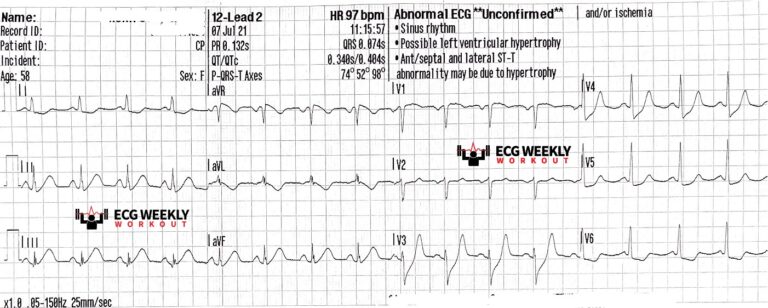 STAT ECG Diagnoses: must know ECG patterns in screening for acute ...