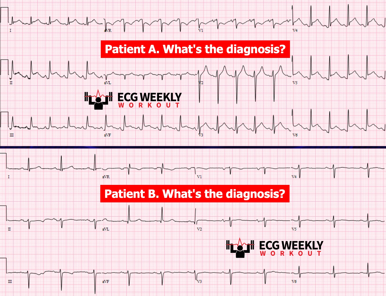 STAT ECG Diagnoses: are ECG abnormalities necessary for the diagnosis ...