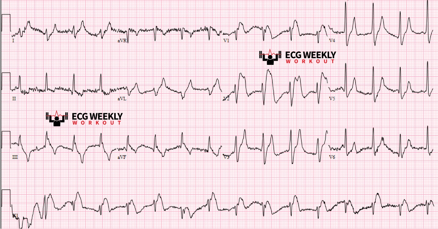 Case 442 – ECG Weekly
