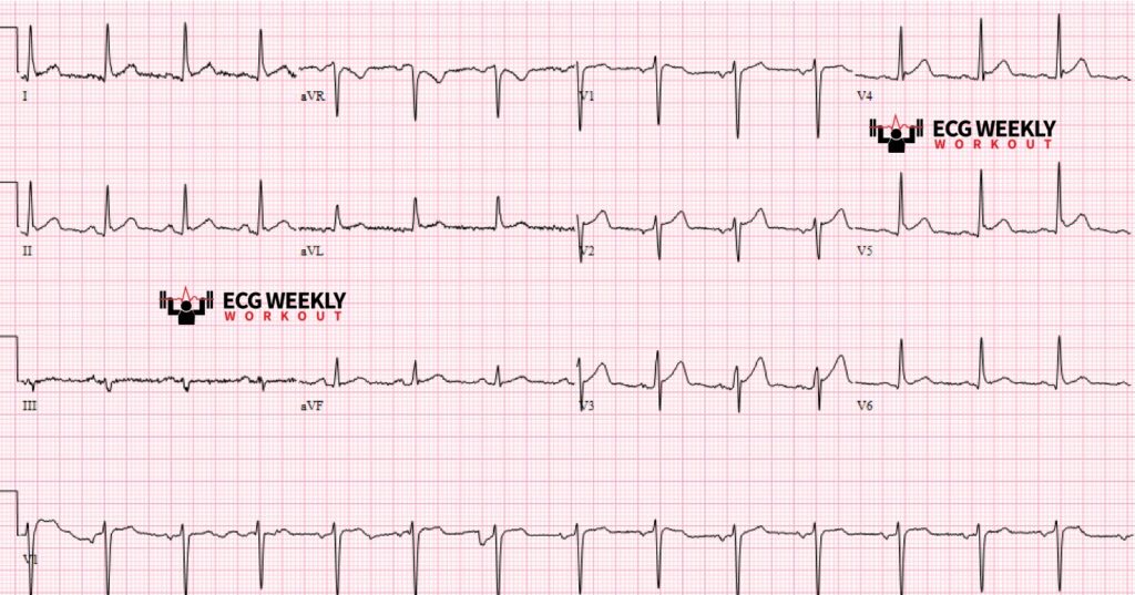 Case 443 – ECG Weekly