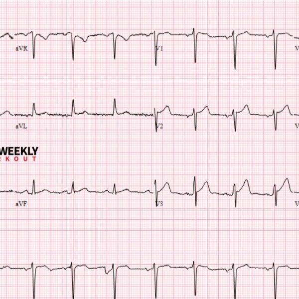 Diffuse ST-segment Elevation – ECG Weekly Diffuse ST-segment Elevation – ECG Weekly