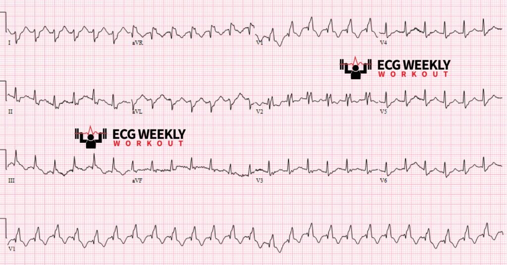 Wide Complex Tachycardias: using old ECGs, Lewis leads, and rabbit ears ...