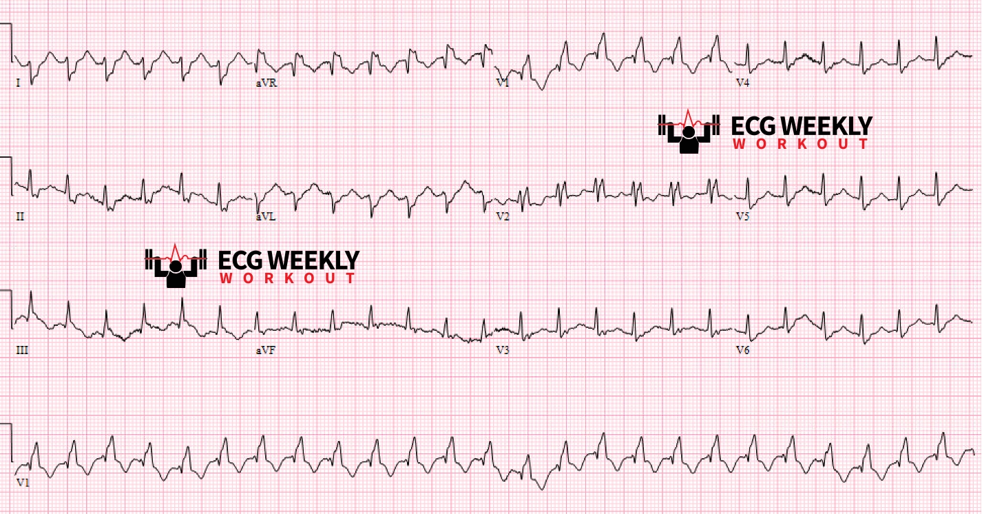 Case 444 – ECG Weekly