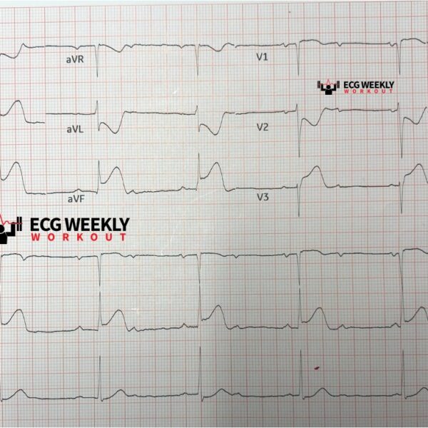 Chest Pain – ECG Weekly