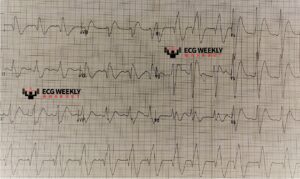 Differential Diagnoses: must know causes of right axis deviation and ...