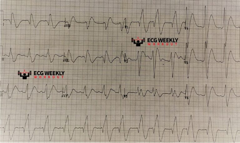 Differential Diagnoses: must know causes of right axis deviation and ...