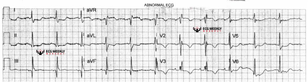 STAT ECG Diagnoses: recognition of life threatening ECG patterns before ...