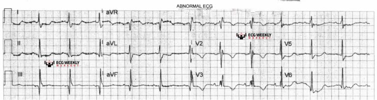 STAT ECG Diagnoses: recognition of life threatening ECG patterns before ...