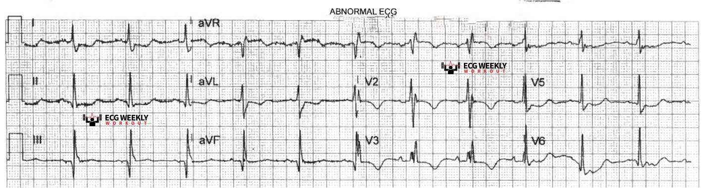 STAT ECG Diagnoses: recognition of life threatening ECG patterns before ...