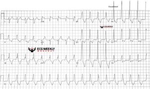 Wide Complex Tachycardias: review of ventricular rhythms, benign and ...