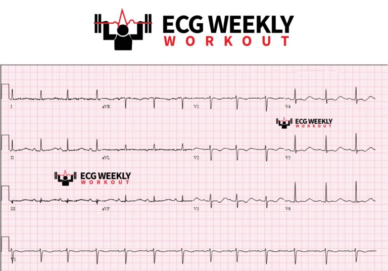 5 more challenging cases from UMEM to test your ECG diagnostic skills ...