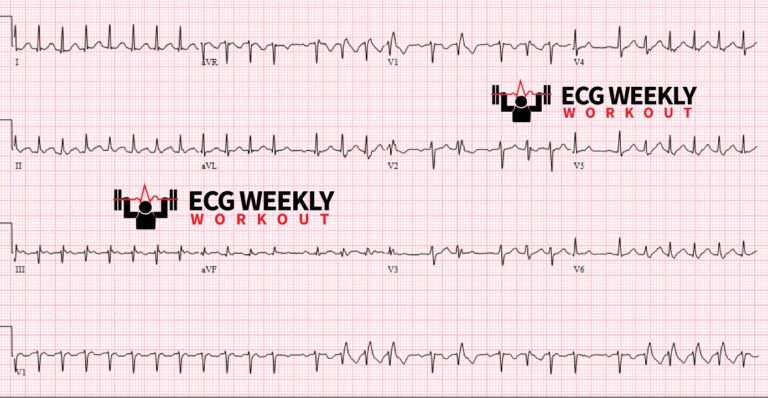 Rhythm Interpretation: Ashman phenomenon vs. nonsustained ventricular ...