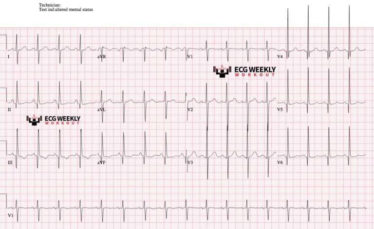 Differential Diagnoses: must know cardiac causes of syncope – ECG Weekly