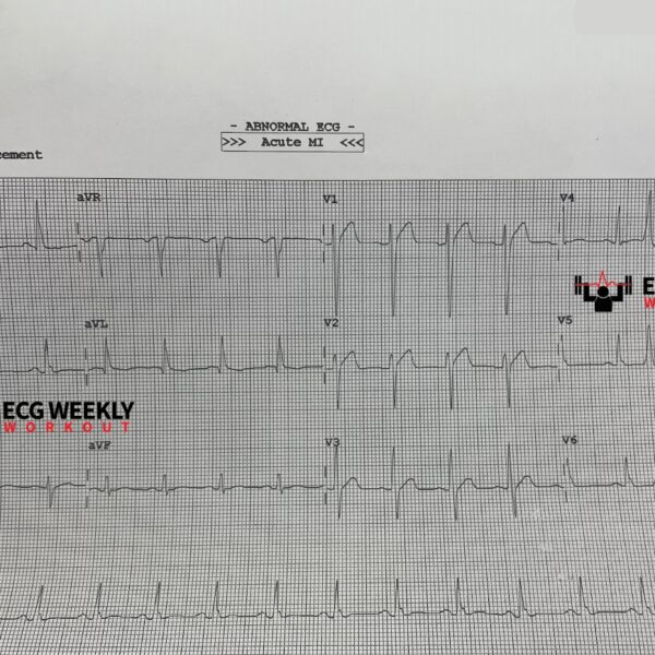STEMI mimics – ECG Weekly