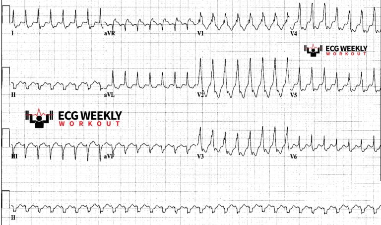 Wide Complex Tachycardias: can ECG algorithms safely rule out ...