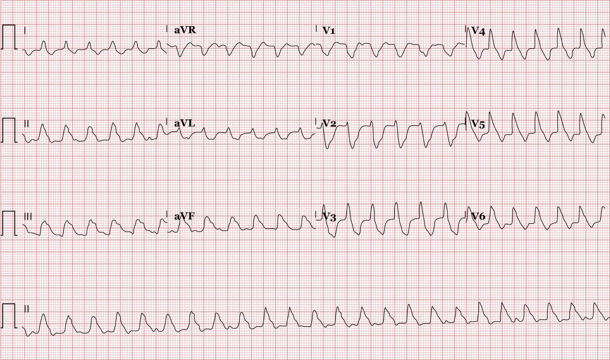 Case 462 – ECG Weekly