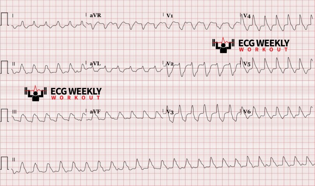 Case 462 – ECG Weekly
