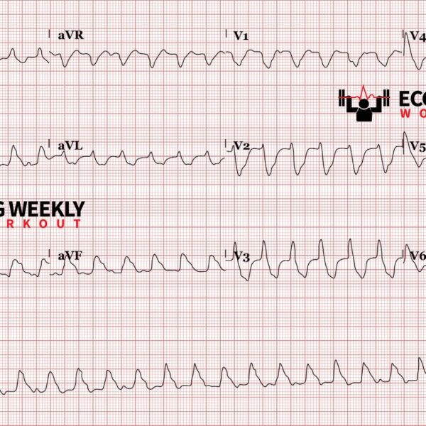 Ventricular tachycardia mimics – ECG Weekly