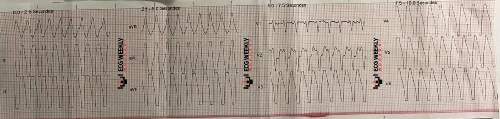 Wide Complex Tachycardias: precordial concordance and what to do when some leads appear narrow ...