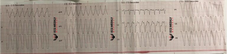 Wide Complex Tachycardias: precordial concordance and what to do when ...
