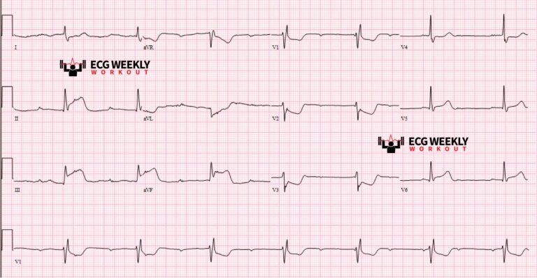 Must Know ECGs and Differentials in Patients with Acute Chest Pain or Shortness of Breath – ECG ...