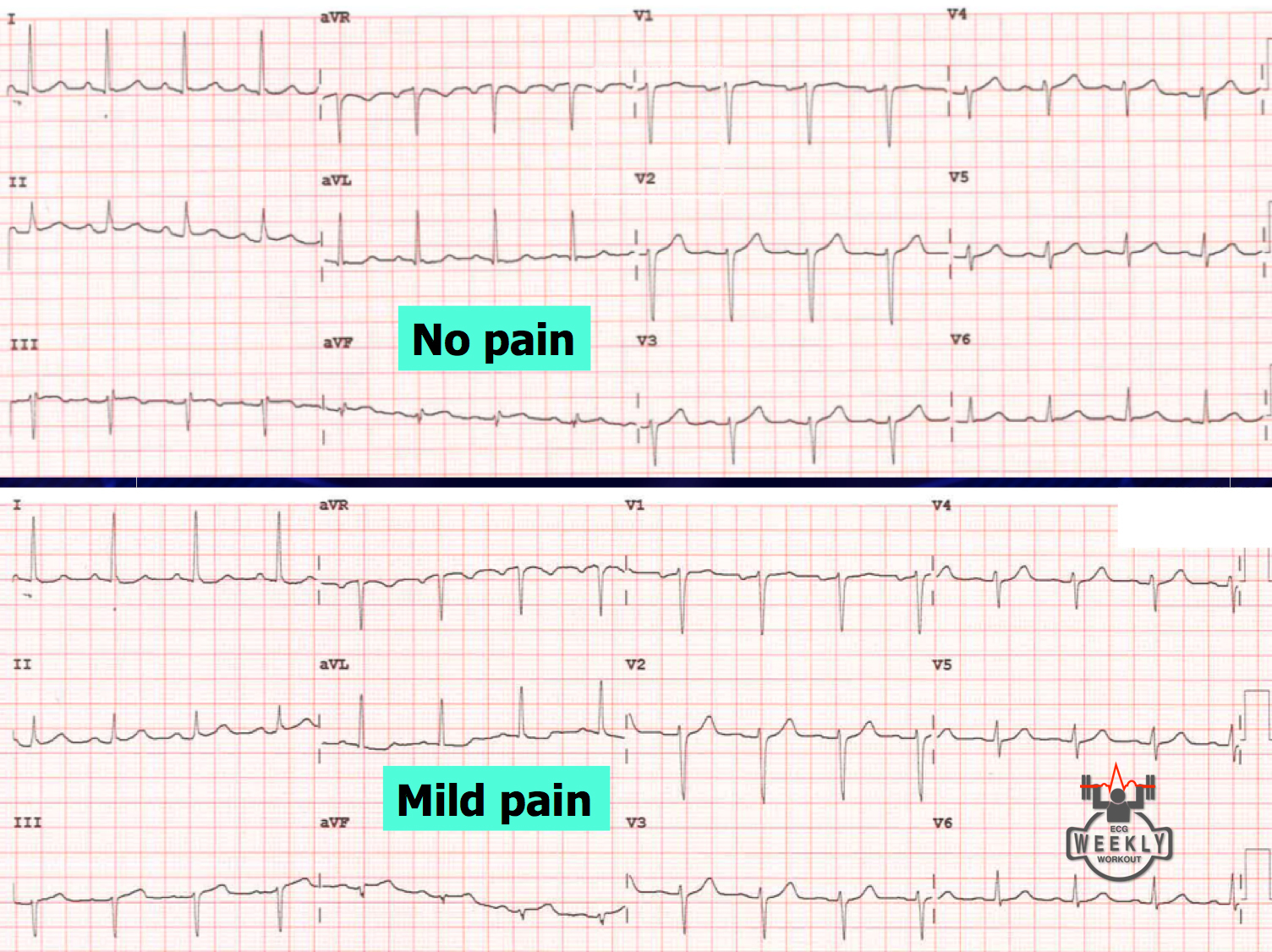 ECG Basics & Fundamentals: dynamic ischemic ECG changes in ACS – ECG Weekly