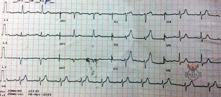 Cardiac arrest after this ECG: what is the most likely cause? – ECG Weekly