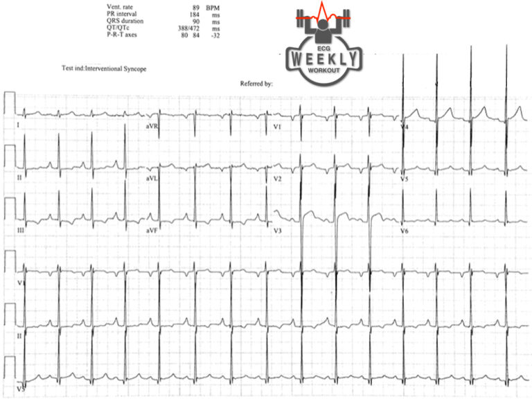 Literature Review Syncope Evaluation In A Young Athlete A Review Of Normal Vs Abnormal Ecg In