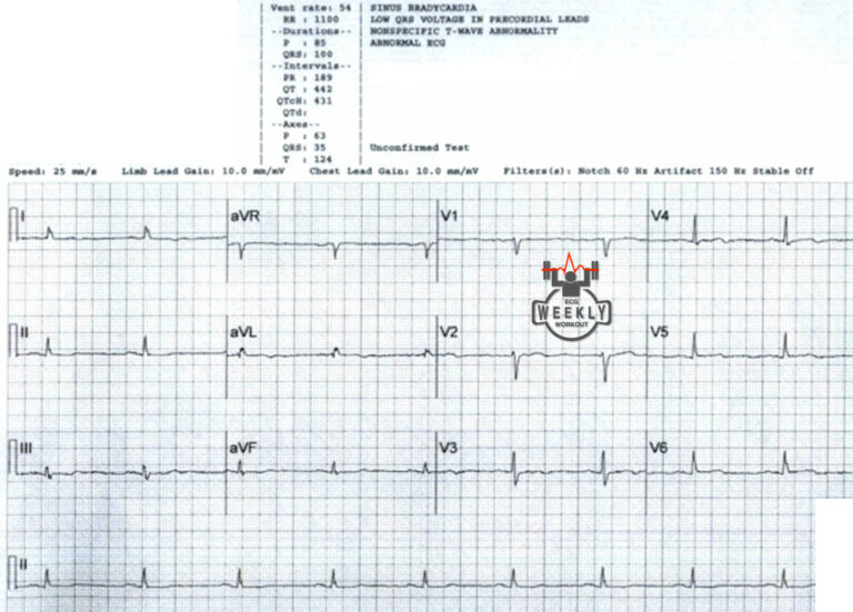 Literature Review: non-ST segment elevation ACS – ECG Weekly