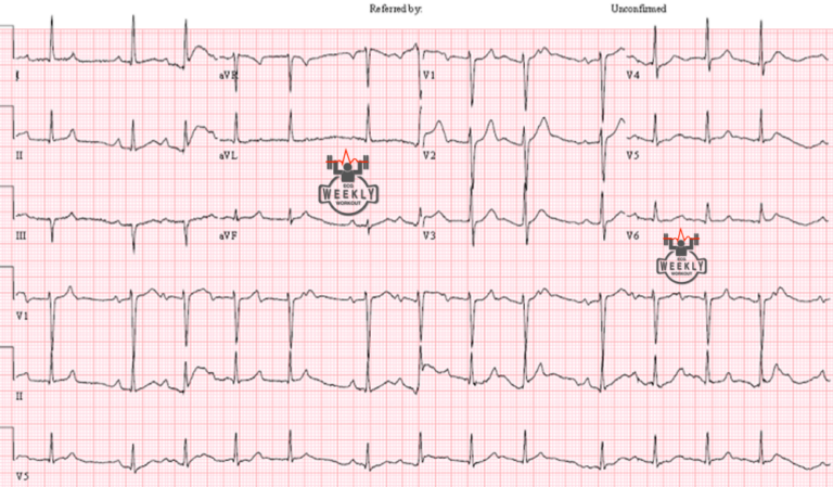 Differential Diagnoses: left axis deviation, fasicular block, and AV ...