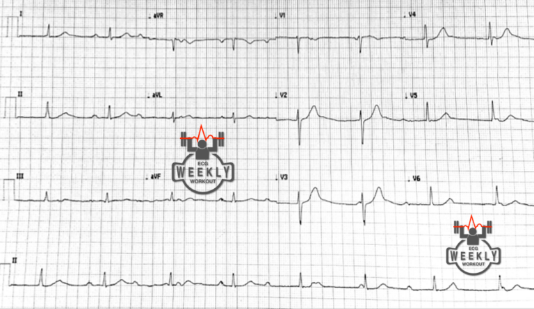 Narrow vs. wide complex QRS in patients with complete heart block – ECG ...
