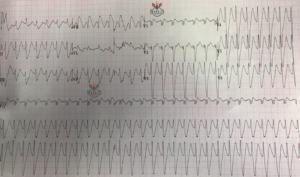 Differential Diagnoses: must know causes of wide QRS complexes – ECG Weekly