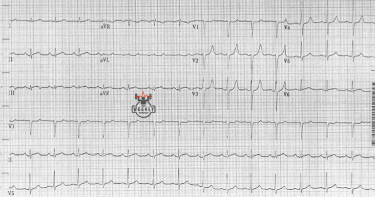 ECG Basics & Fundamentals: when a T wave inversion in lead aVL matters ...
