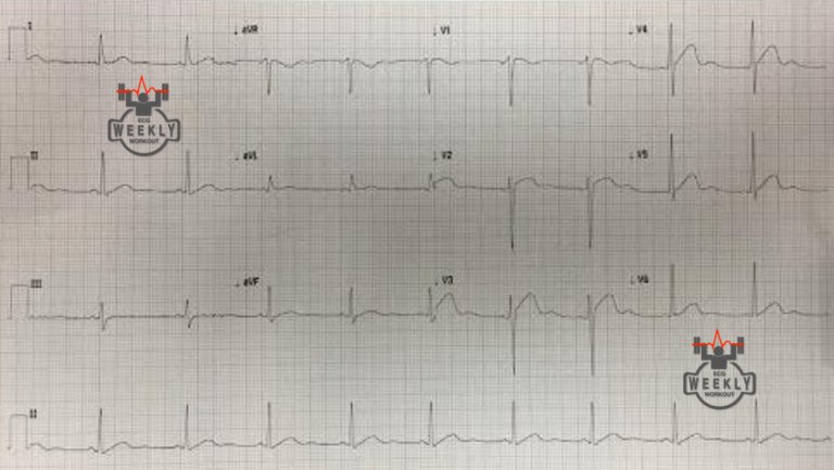 Differential Diagnoses: over 15 causes of ST segment elevation…there is much more than STEMI ...
