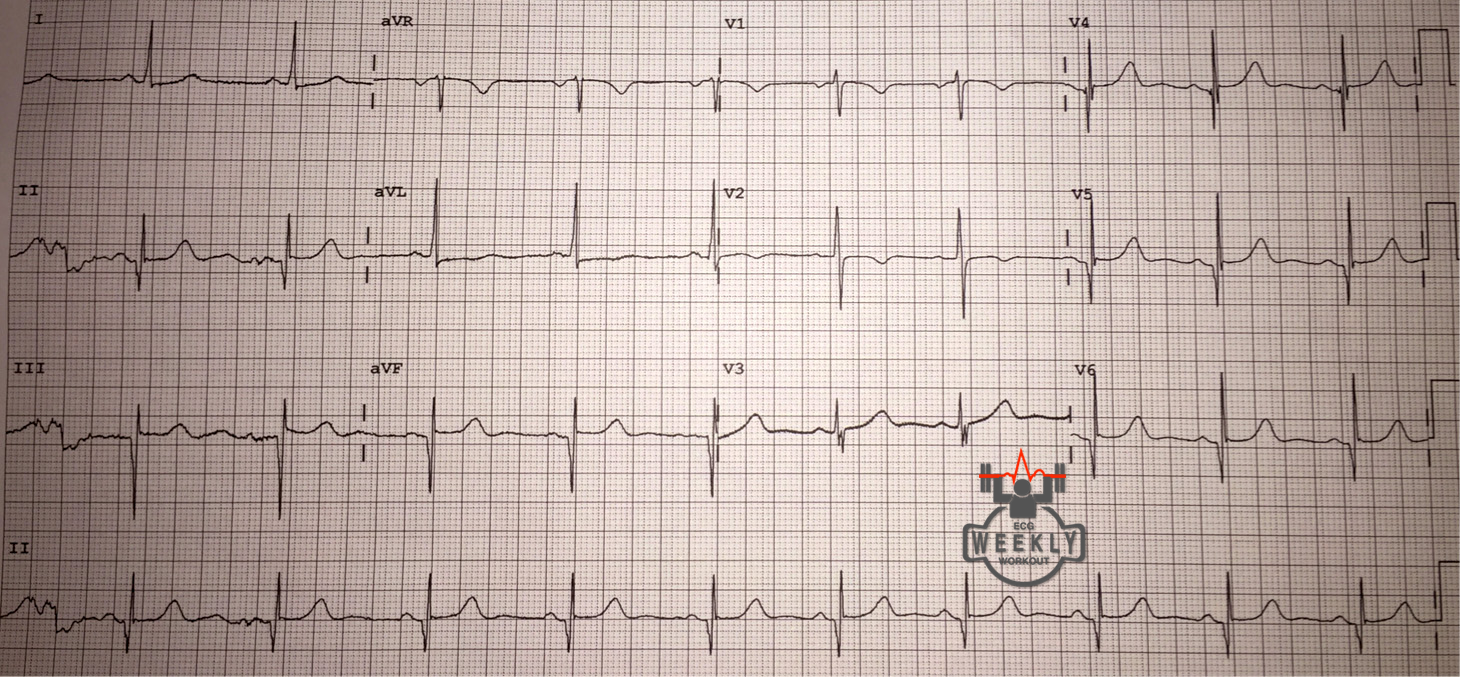 Differential Diagnoses: life threatening causes of syncope – ECG Weekly