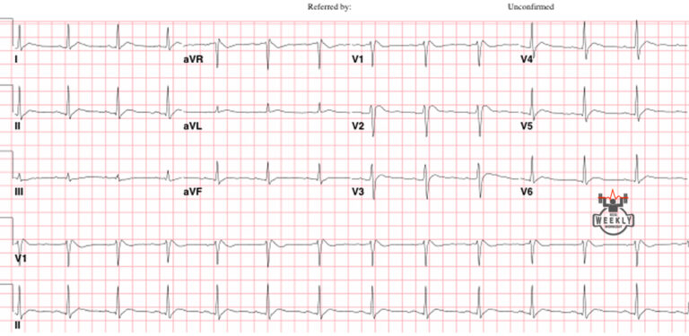 ECG Basics & Fundamentals: using a systematic approach to identify the ... ECG Basics & Fundamentals: using a systematic approach to identify the ...