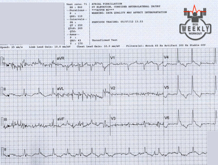 ECG findings in hypothermia – ECG Weekly