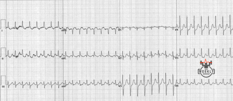 Differential Diagnoses: supraventricular tachycardia with ST segment ...
