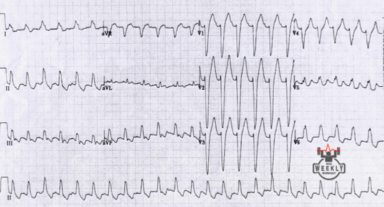 ECG Basics & Fundamentals: inspecting T waves closely, looking for buried P waves – ECG Weekly
