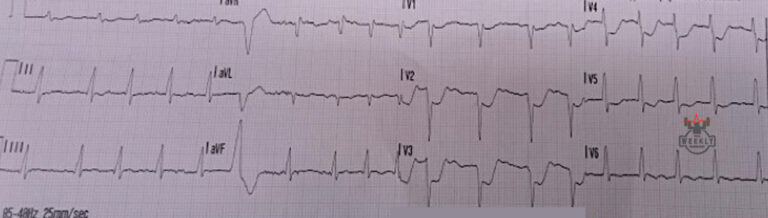STAT ECG Diagnoses: the most commonly missed STEMI does not have ST ...