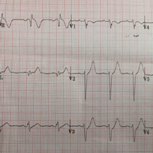 STEMI equivalent – ECG Weekly