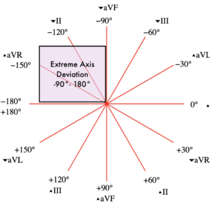 extreme axis deviation – ECG Weekly