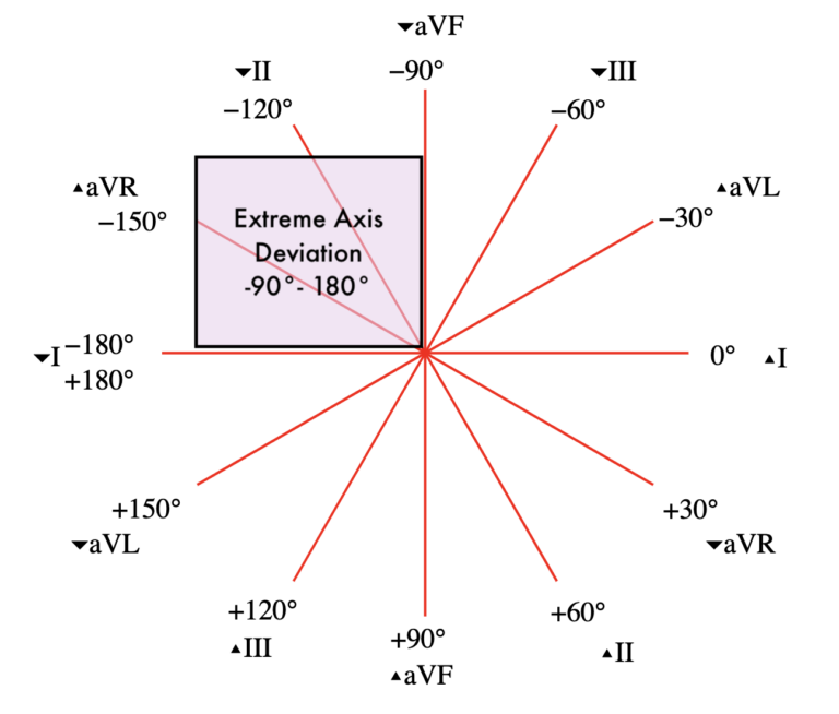 Extreme-Axis-Deviation – ECG Weekly