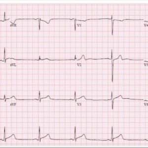 Pericarditis – ECG Weekly