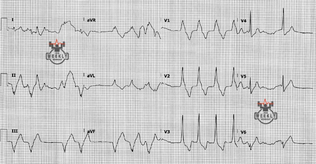 ECG Basics & Fundamentals: ventricular rhythms to be aware of in ...