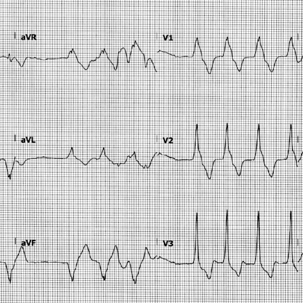 Ventricular Rhythms – ECG Weekly
