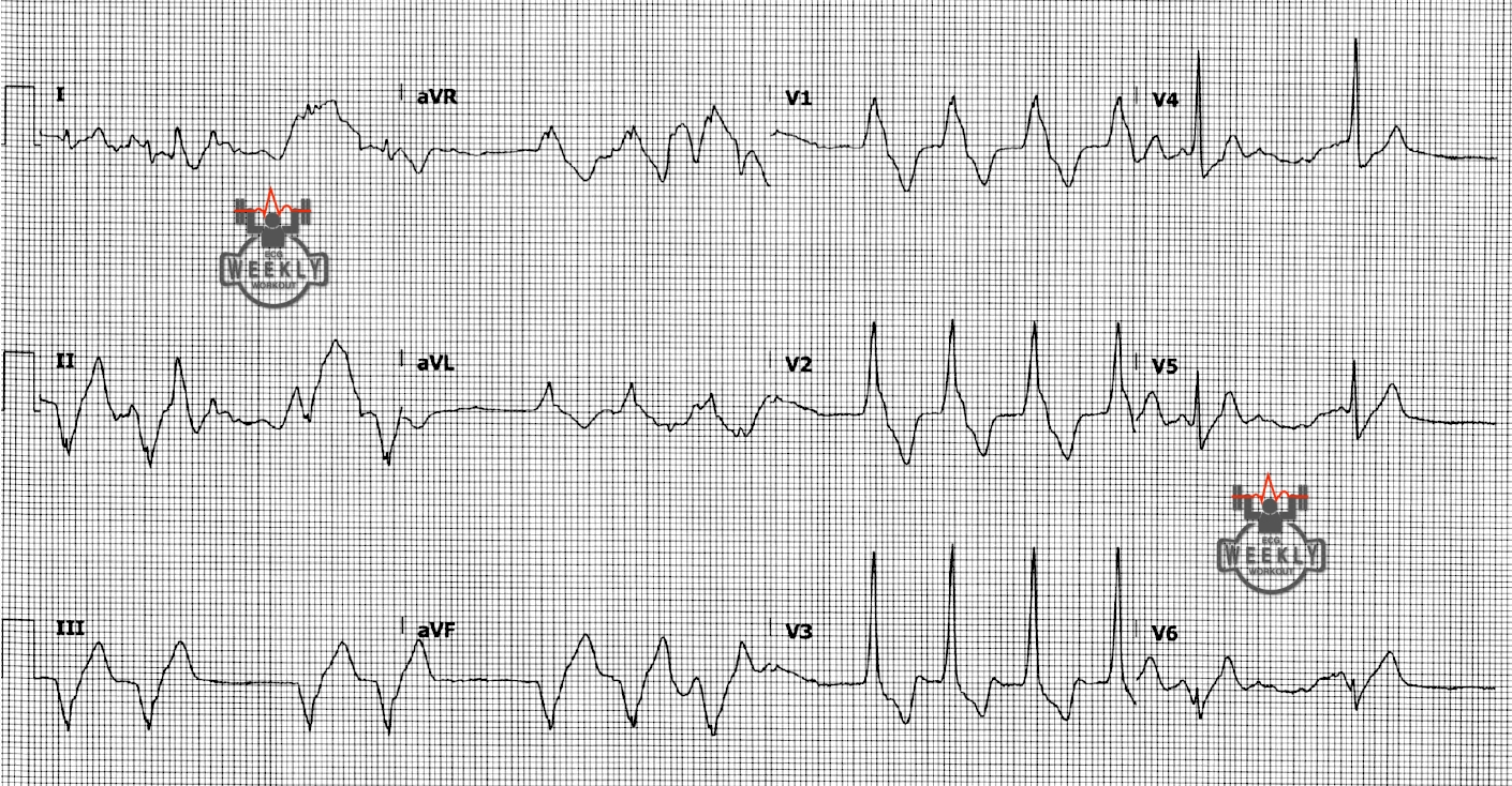 ECG Basics & Fundamentals: ventricular rhythms to be aware of in ...