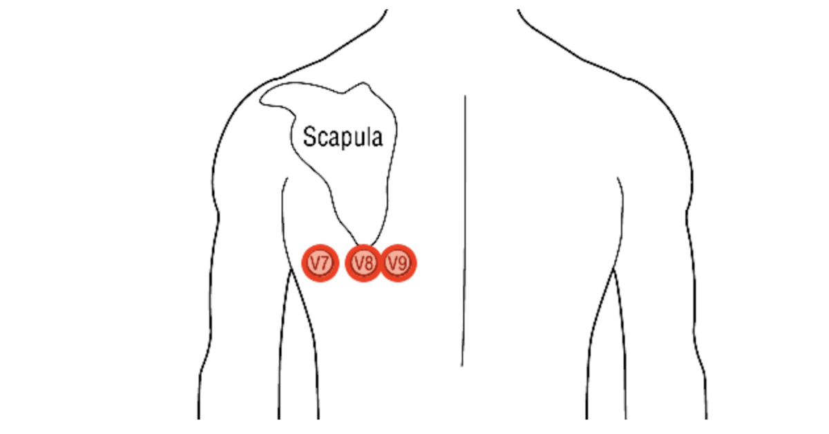 Posterior – ECG Weekly